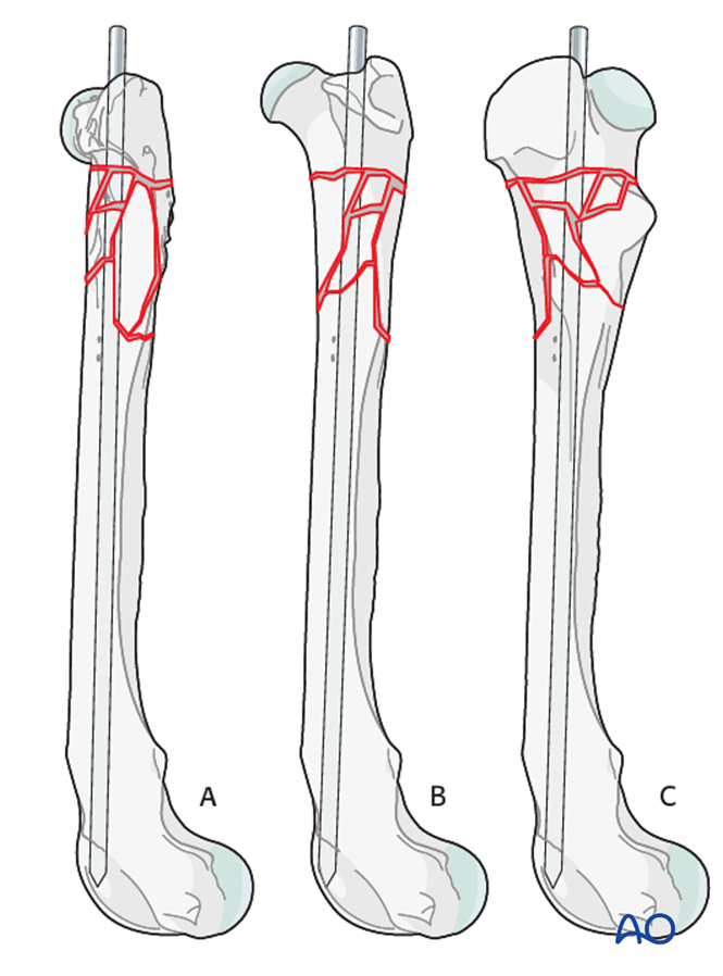 Plate and rod for Trochanteric region, multifragmentary