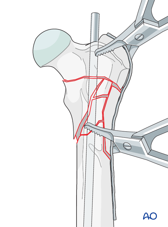 Plate and rod for Trochanteric region, multifragmentary
