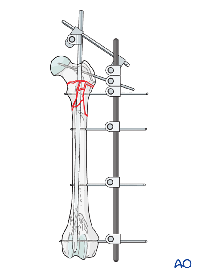 Tie-in technique for Trochanteric region, multifragmentary