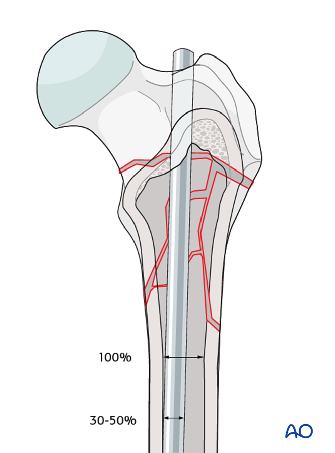 Tie-in technique for Trochanteric region, multifragmentary