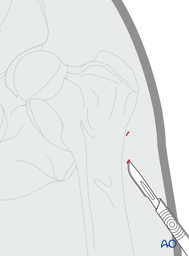 Tie-in technique for Trochanteric region, multifragmentary