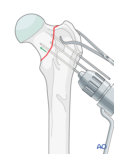 Parallel K-wires for Simple basicervical