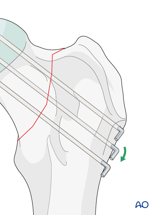 Parallel K-wires for Simple basicervical