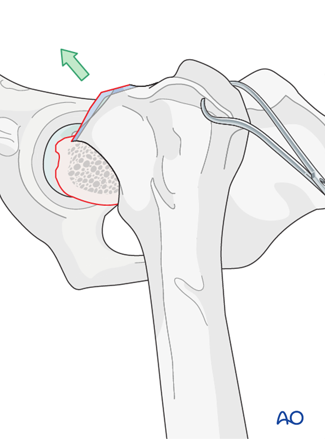 Parallel K-wires for Simple transcervical