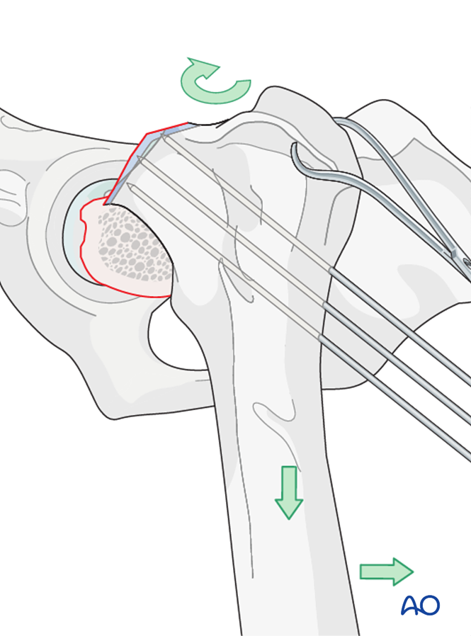 Parallel K-wires for Simple transcervical