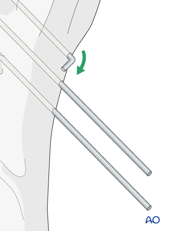 Parallel K-wires for Simple transcervical
