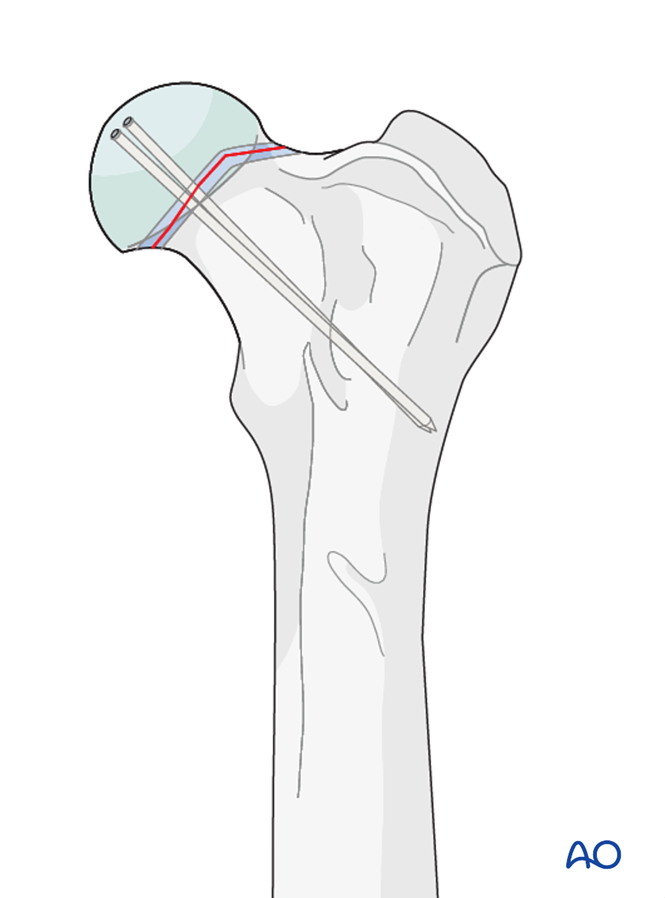 Parallel K-wires for Simple transcervical