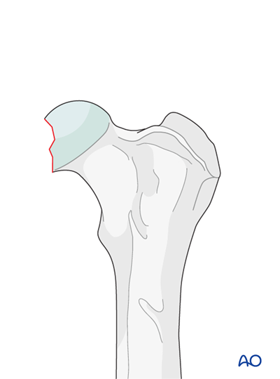 Fragment removal for Capital, articular multifragmentary