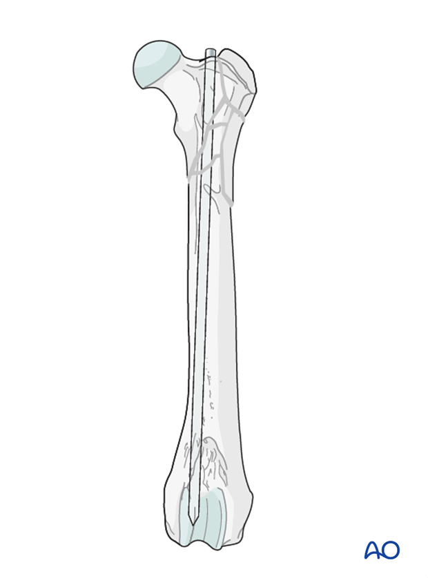 Tie-in technique for Trochanteric region, multifragmentary