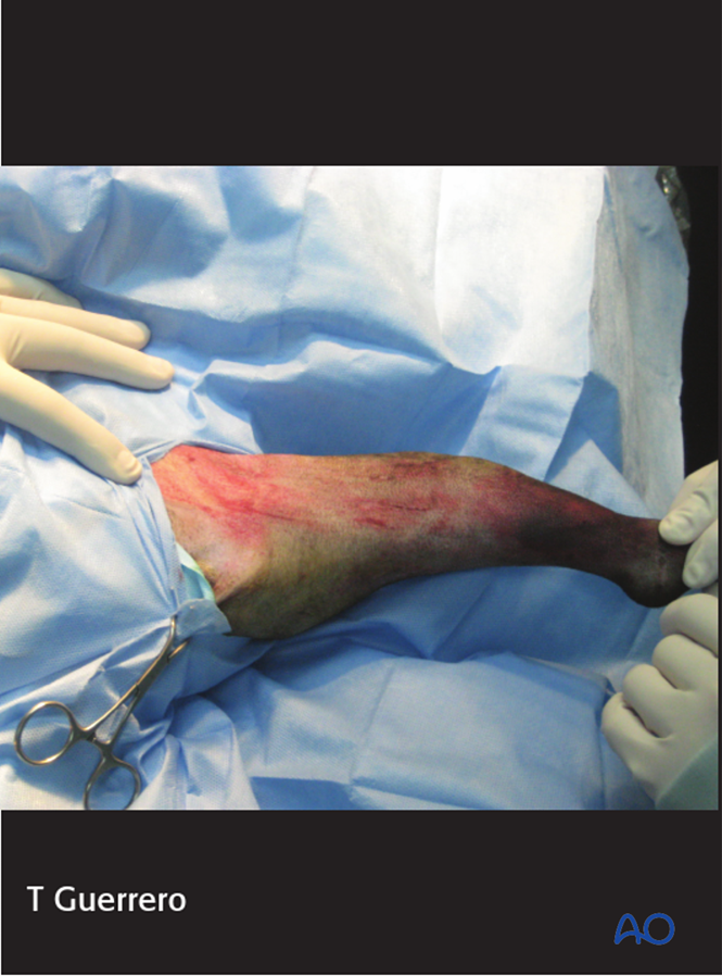 Dorsal recumbency position