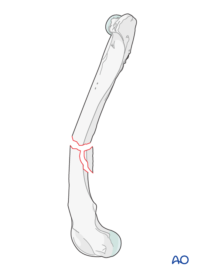 Lag Screw and neutralization plate for Diaphyseal fractures with one ...