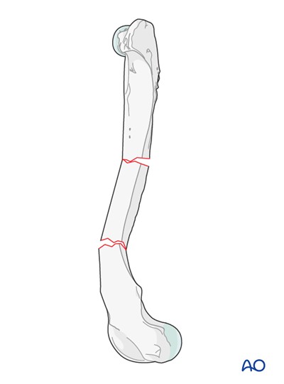 Complex segmental fractures