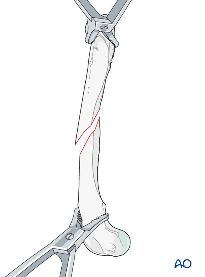 Lag screw and neutralization plate for Simple oblique fractures of the ...