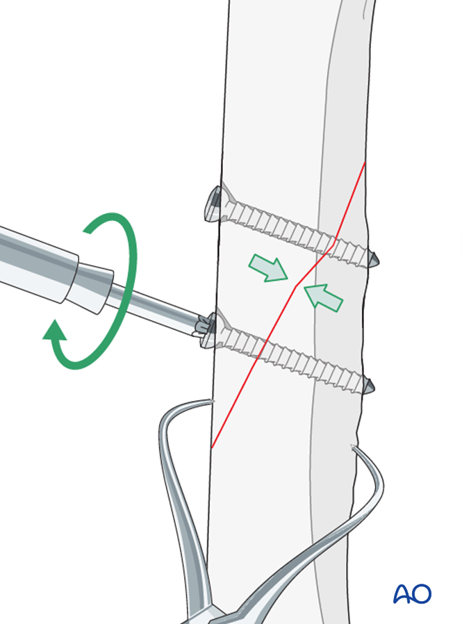 Lag screw fixation