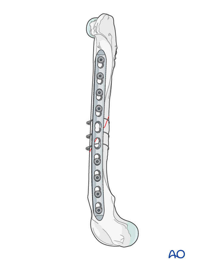 Lag screw and neutralization plate for Simple oblique fractures of the ...