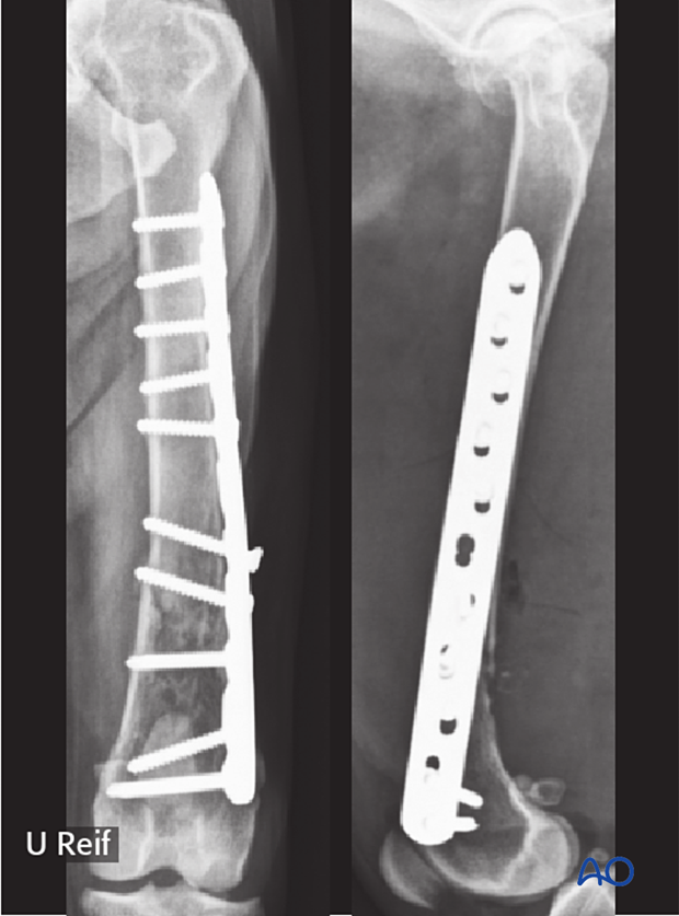 Lag screw and neutralization plate for Simple oblique fractures of the ...