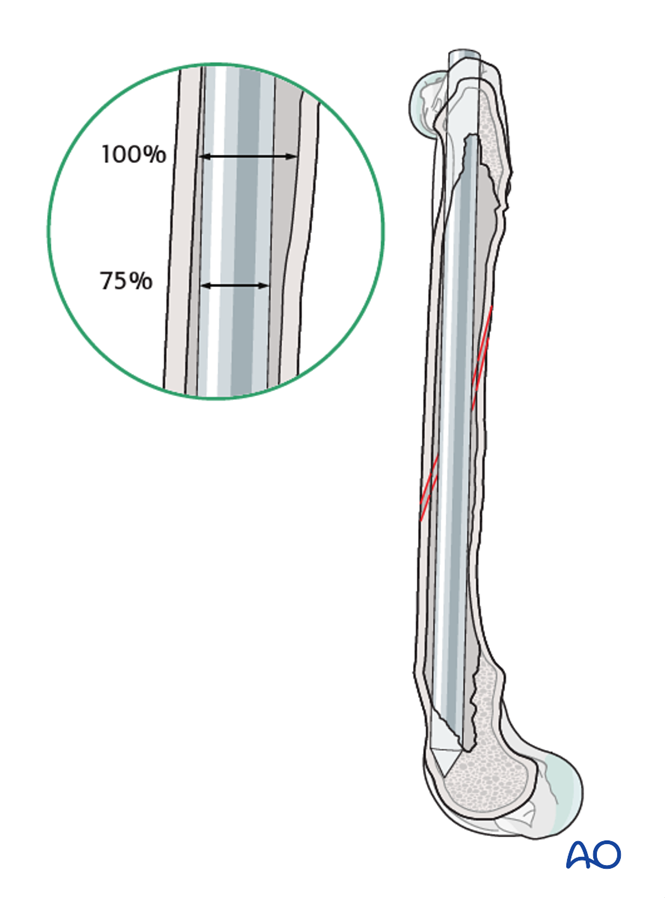 Intramedullary pin fixation with cerclage wires for Simple oblique ...