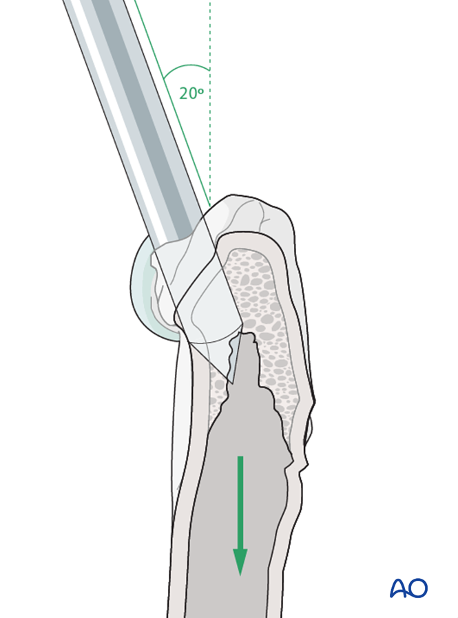 Intramedullary pin fixation with cerclage wires for Simple oblique ...