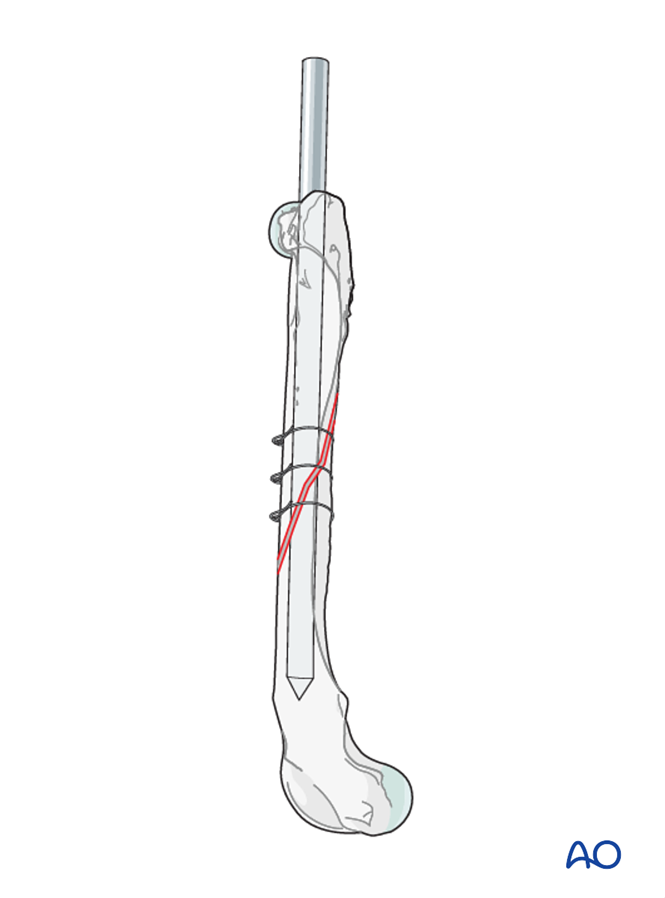 Intramedullary pin fixation with cerclage wires for Simple oblique ...