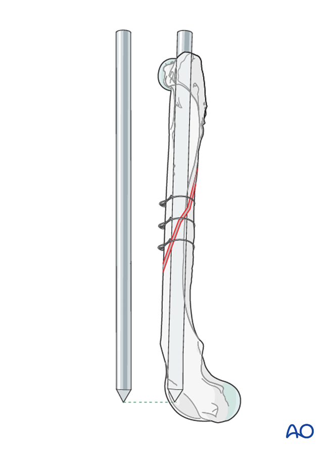 Intramedullary pin fixation with cerclage wires for Simple oblique ...