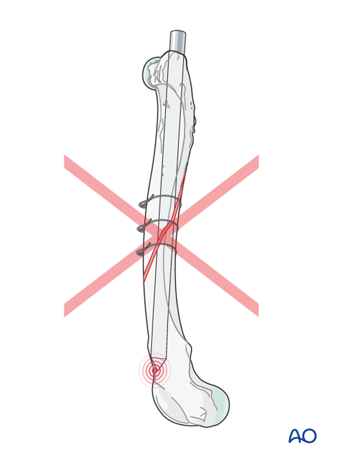 Intramedullary pin fixation with cerclage wires for Simple oblique ...