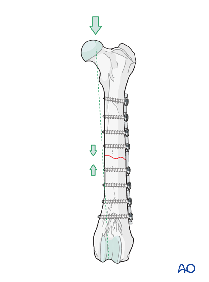 Compression plate for Simple transverse fractures of the femoral diaphysis