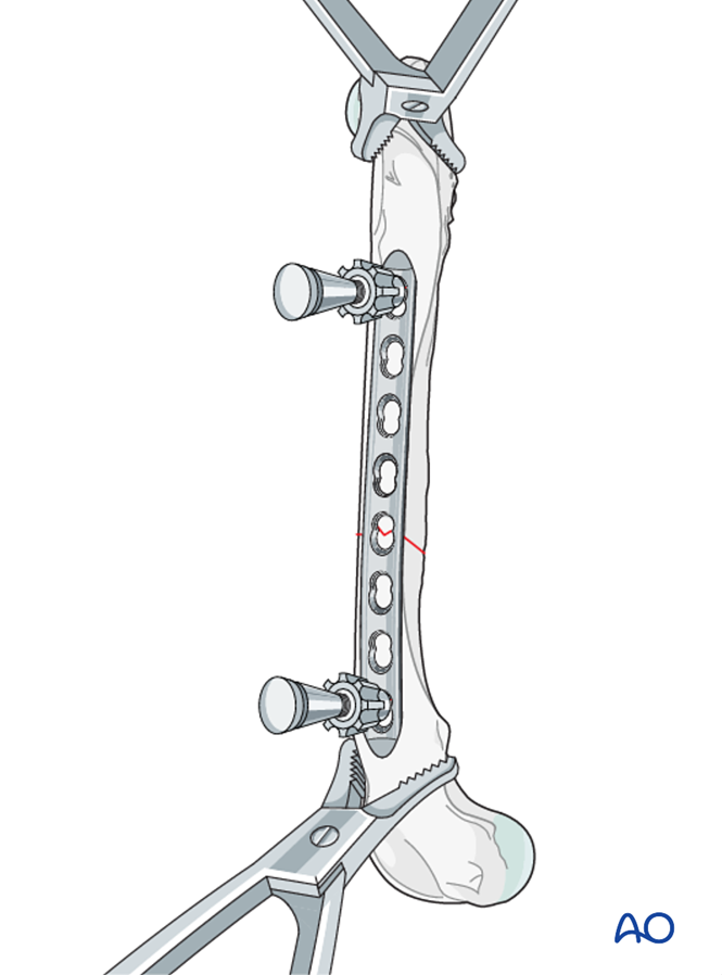 Compression plate for Simple transverse fractures of the femoral diaphysis