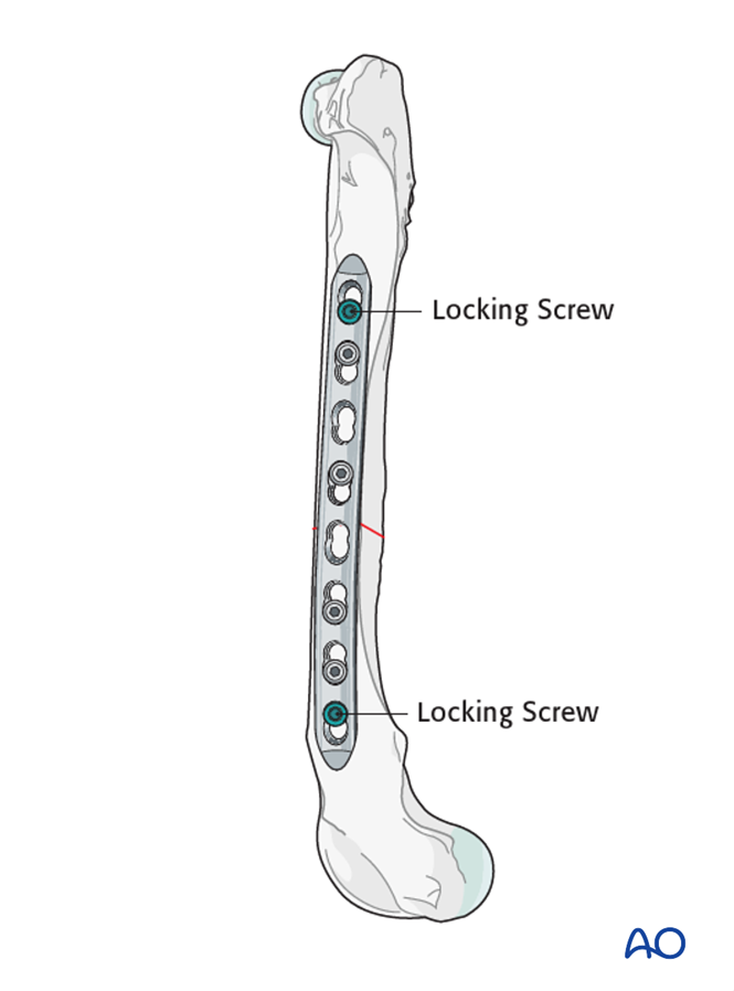 Compression plate for Simple transverse fractures of the femoral diaphysis