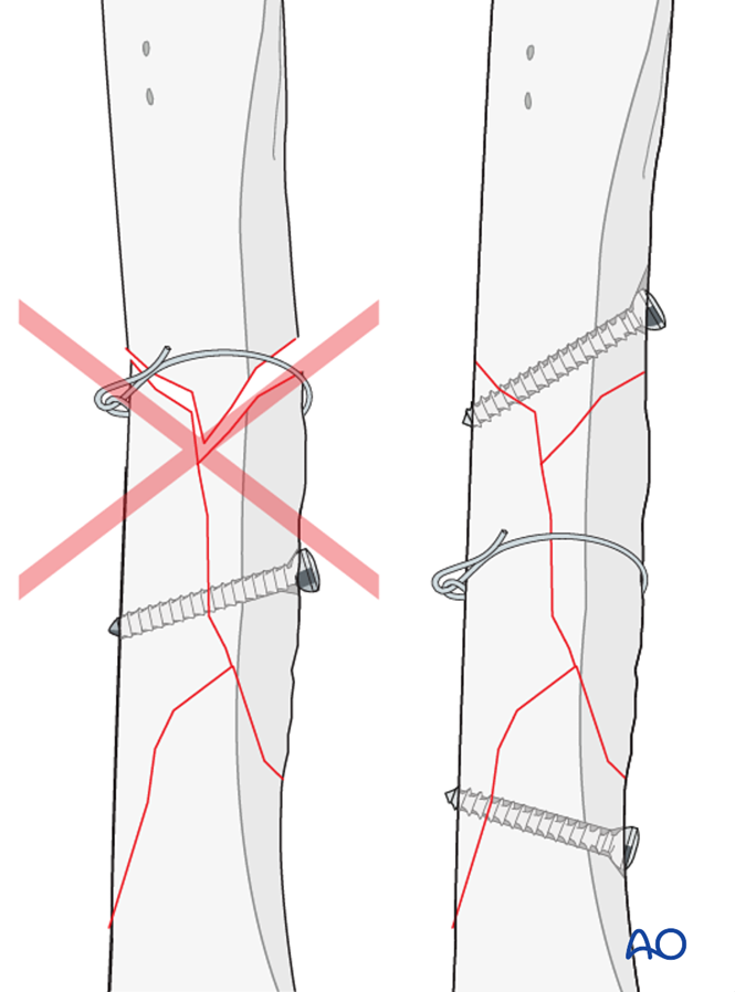 Lag Screw and neutralization plate for Complex diaphyseal fractures ...