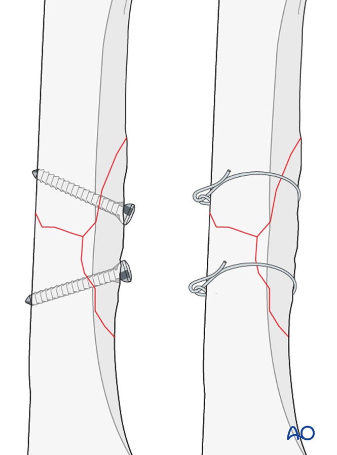 Lag Screw and neutralization plate for Diaphyseal fractures with one ...