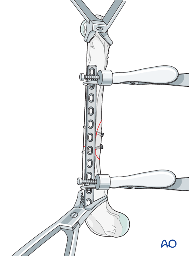 Lag Screw and neutralization plate for Diaphyseal fractures with one ...