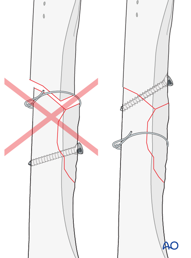 Cerclage wires technique
