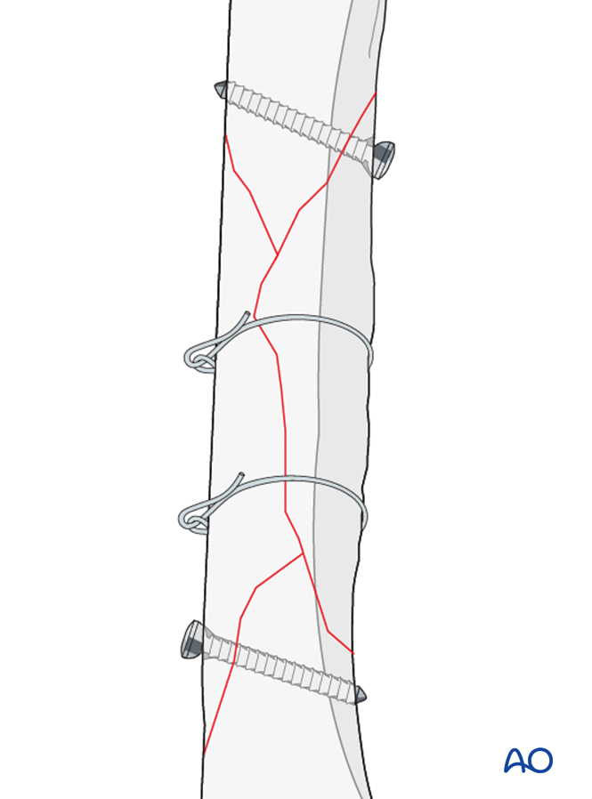 Lag Screw and neutralization plate for Complex diaphyseal fractures ...