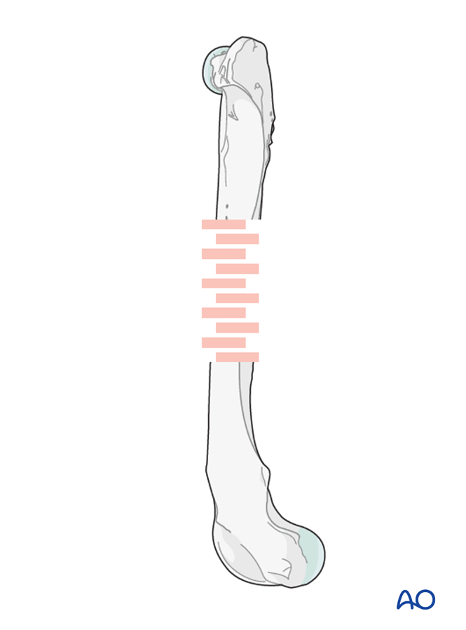 Plate and rod for Complex fractures with non reconstructible wedges and ...