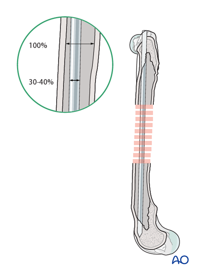 Plate and rod for Complex fractures with non reconstructible wedges and ...