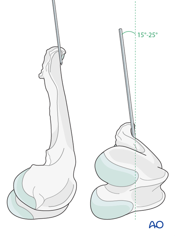 Plate and rod for Complex fractures with non reconstructible wedges and ...