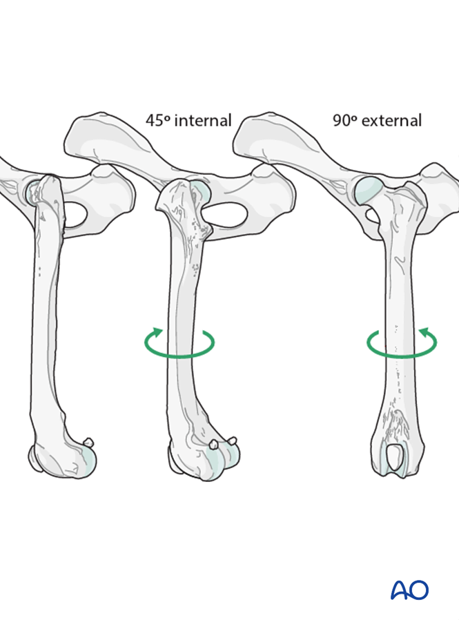 Plate and rod for Complex fractures with non reconstructible wedges and ...