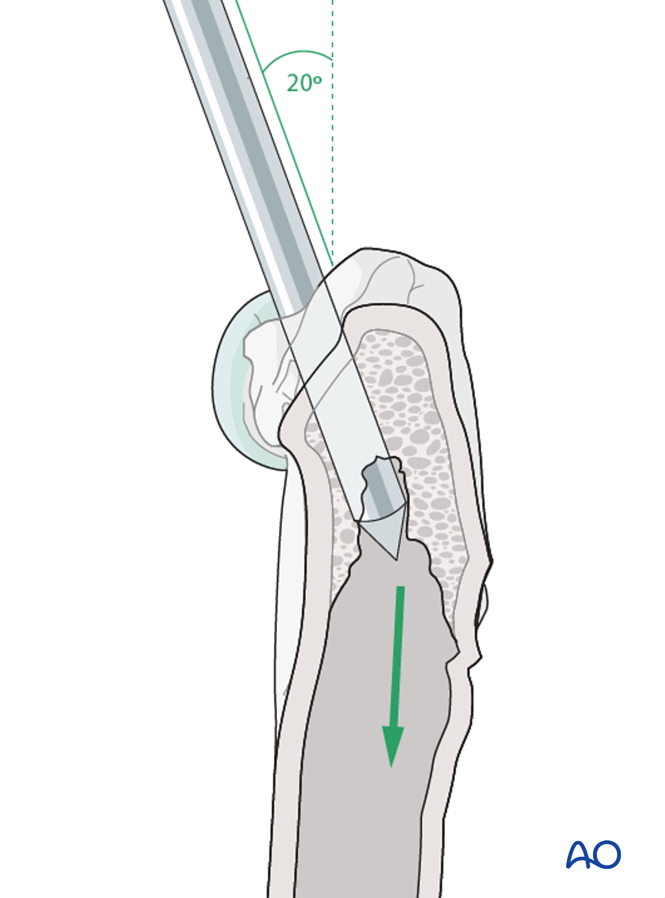 Plate and rod for Diaphyseal fractures with greater than 1 ...