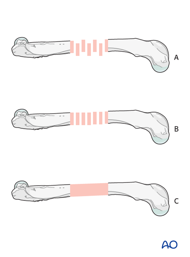Plate and rod for Complex fractures with non reconstructible wedges and ...