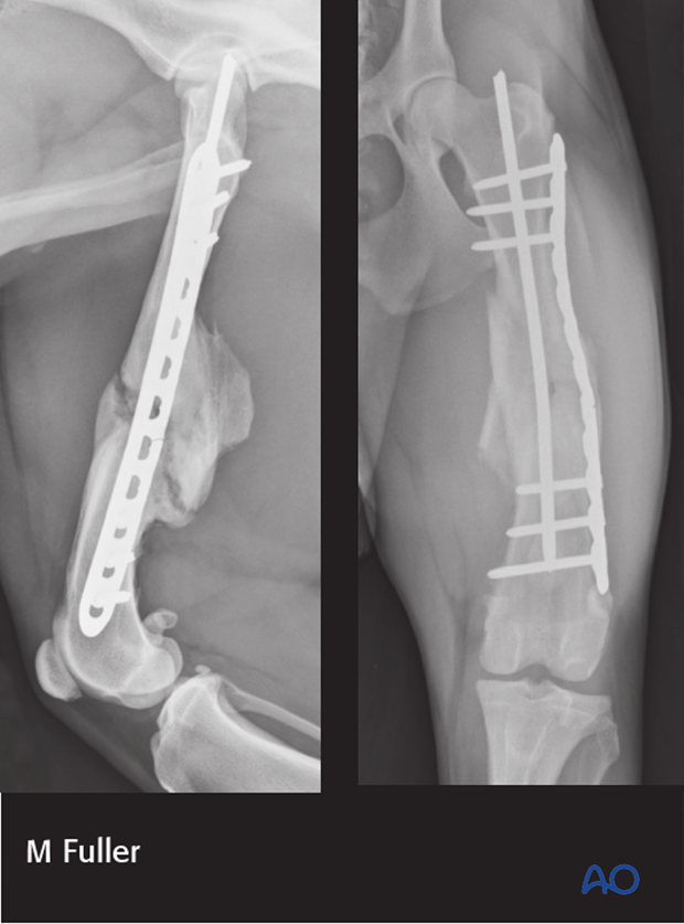 Plate and rod for Complex diaphyseal fractures anatomically reconstructible