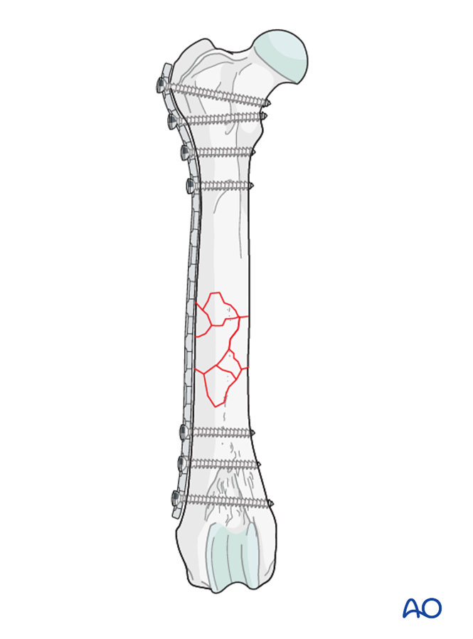 Bridging plate and alternative double plating for Diaphyseal fractures ...