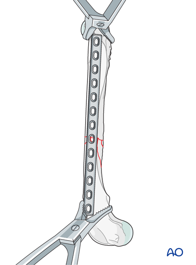 Bridging plate for Diaphyseal fractures with greater than 1 ...