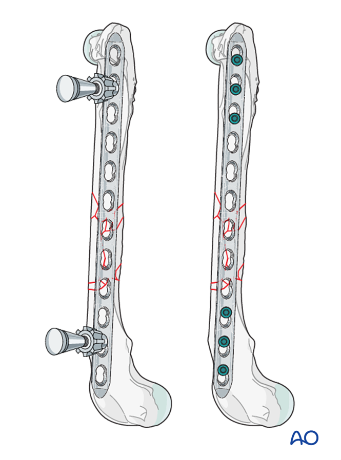 Bridging plate and alternative double plating for Complex fractures ...