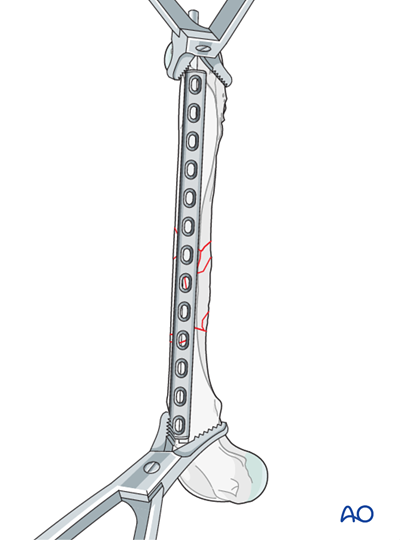 Bridging plate and alternative double plating for Complex fractures ...