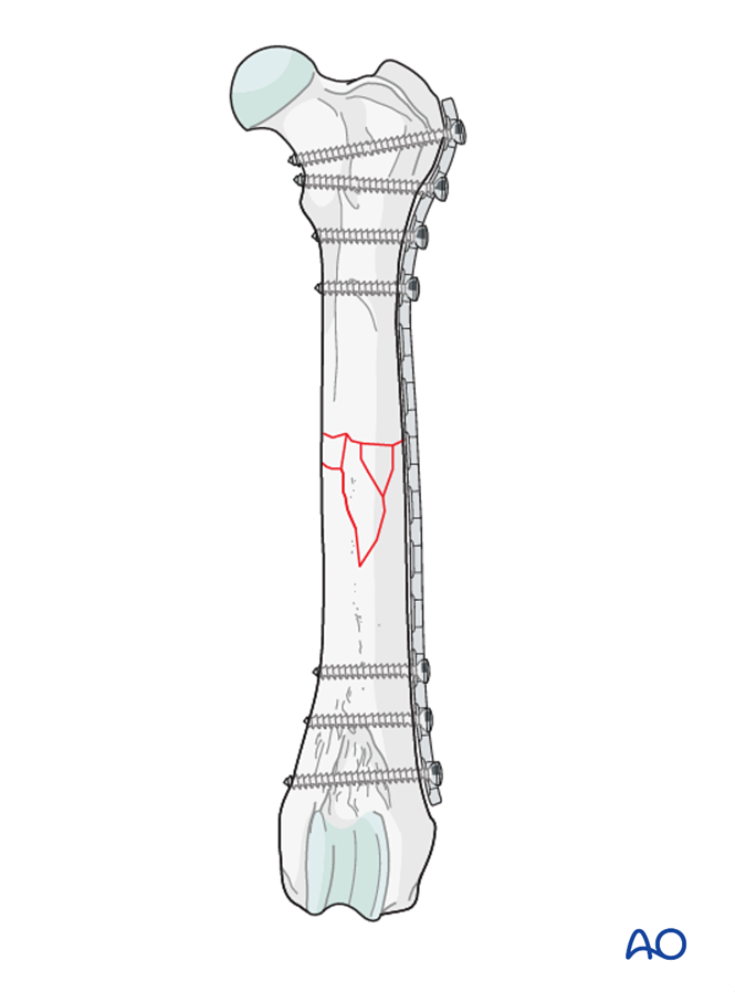 Bridging plate for Diaphyseal fractures with greater than 1 ...