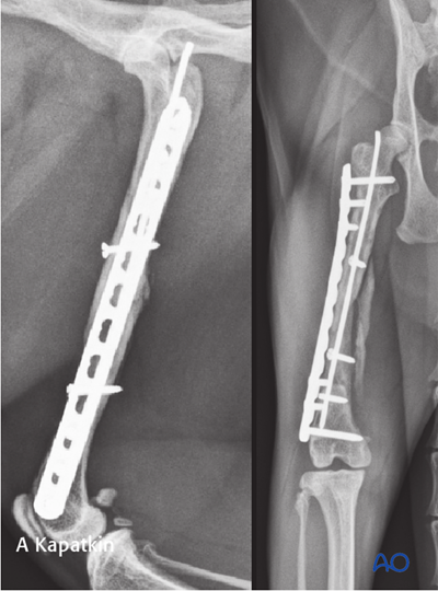 Bridging plate and alternative double plating for Complex fractures ...
