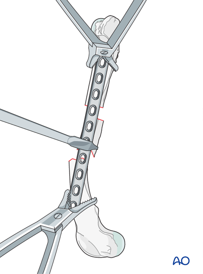Compression plate for Complex segmental fractures