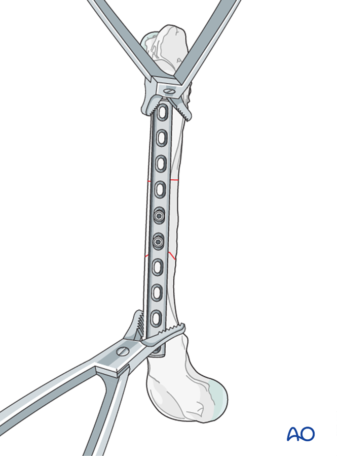 Compression plate for Complex segmental fractures