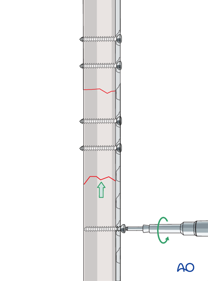 Compression plate for Complex segmental fractures