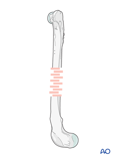Tie-in technique for Complex fractures with non reconstructible wedges ...